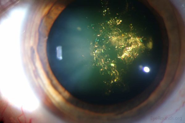 Christmas tree cataract - Choroida